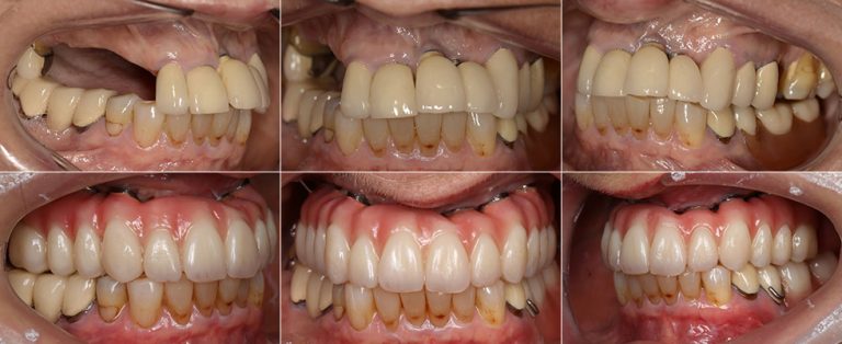 Replacing teeth - Sydney Dental Specialists
