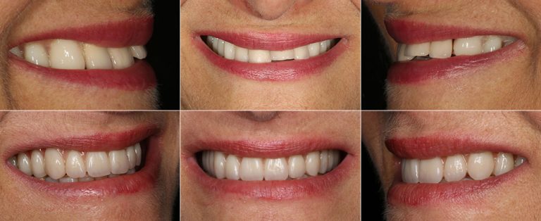 Replacing teeth - Sydney Dental Specialists